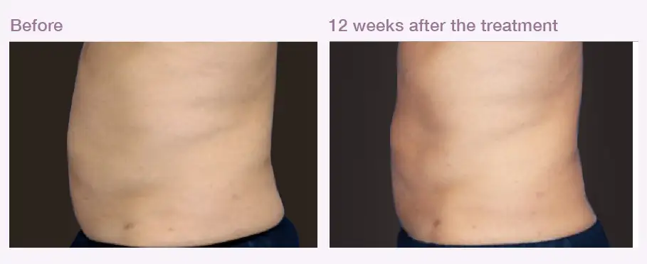TruSculpt Flex - Non-Invasive Muscle Sculpting and Body Contouring ...