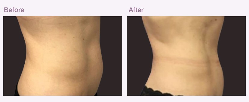 TruSculpt Flex - Non-Invasive Muscle Sculpting and Body Contouring ...